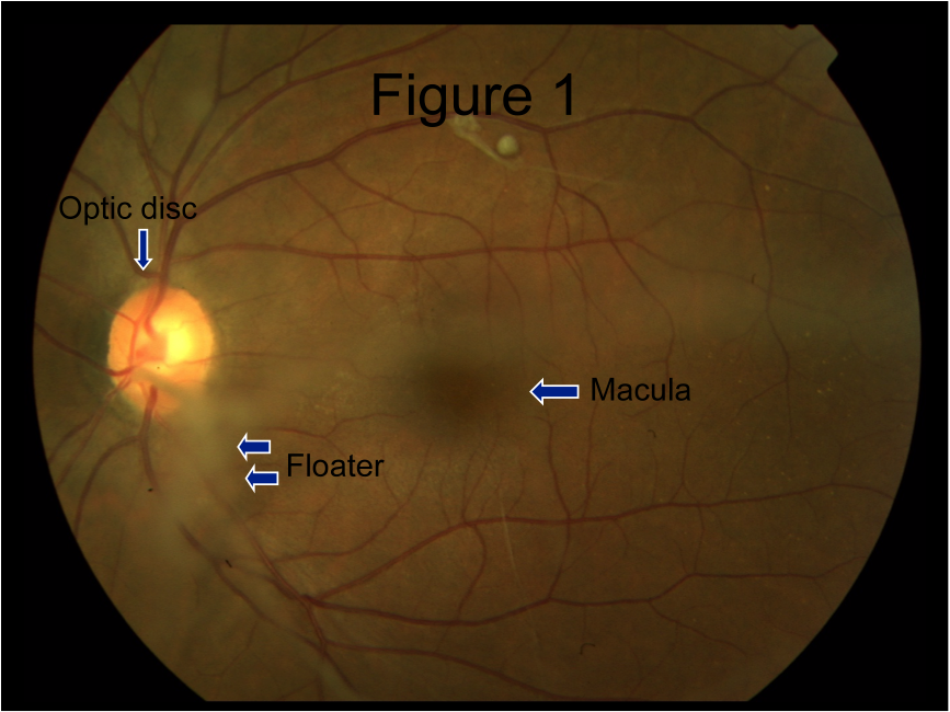What Are The Small Black Dots In My Vision Doctify What Are The Small Black Dots In My Vision Doctify