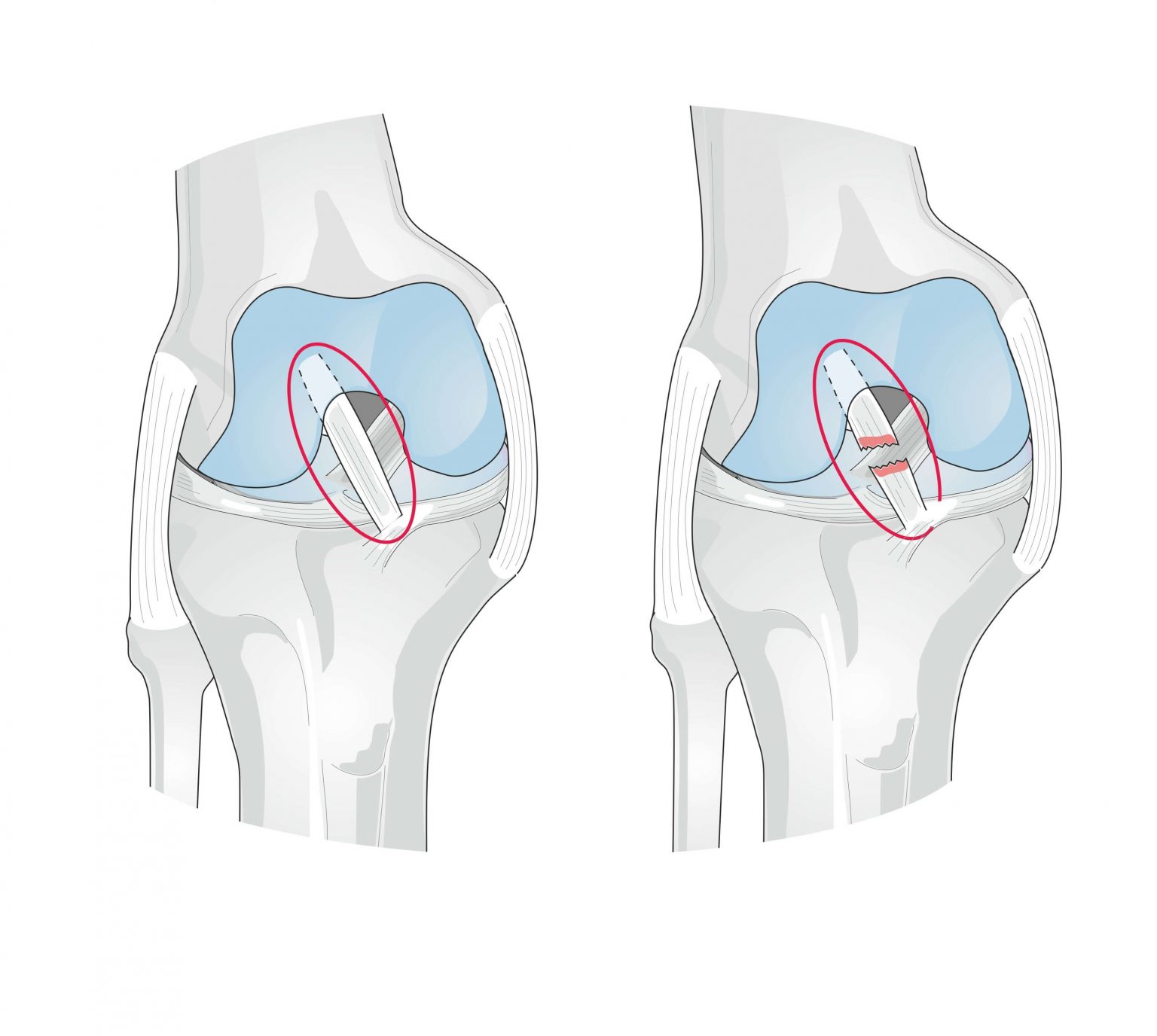 ACL Injury - Symptoms & Treatment - Doctify